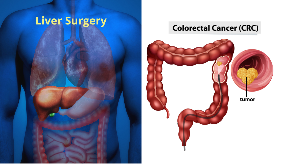 Complex Gl And Colorectal Surgery Experts Sahasra Hospitals
