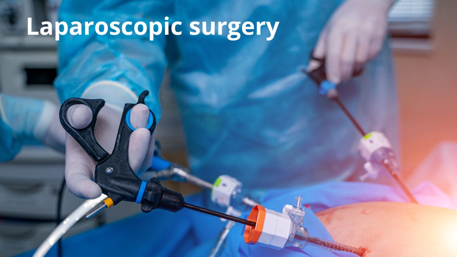 Reasons to have Single Incision Laparoscopic surgery (SILS): - Centre ...
