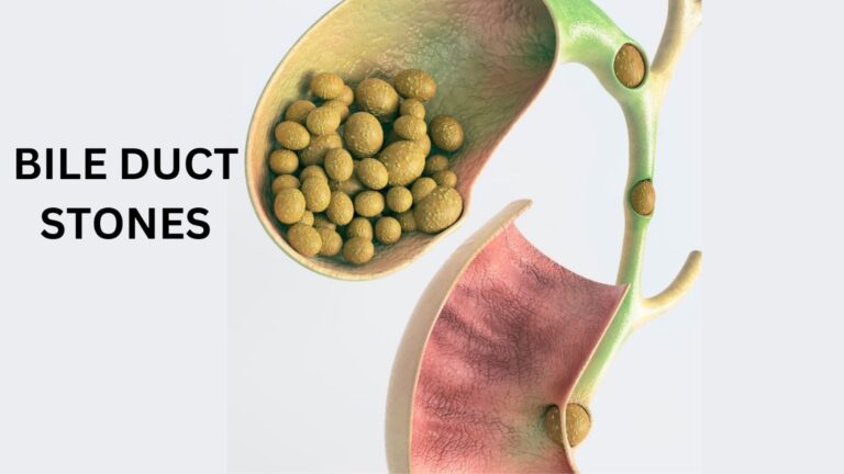 Bile Duct Stones - Centre of Excellence for Minimal Access Surgery